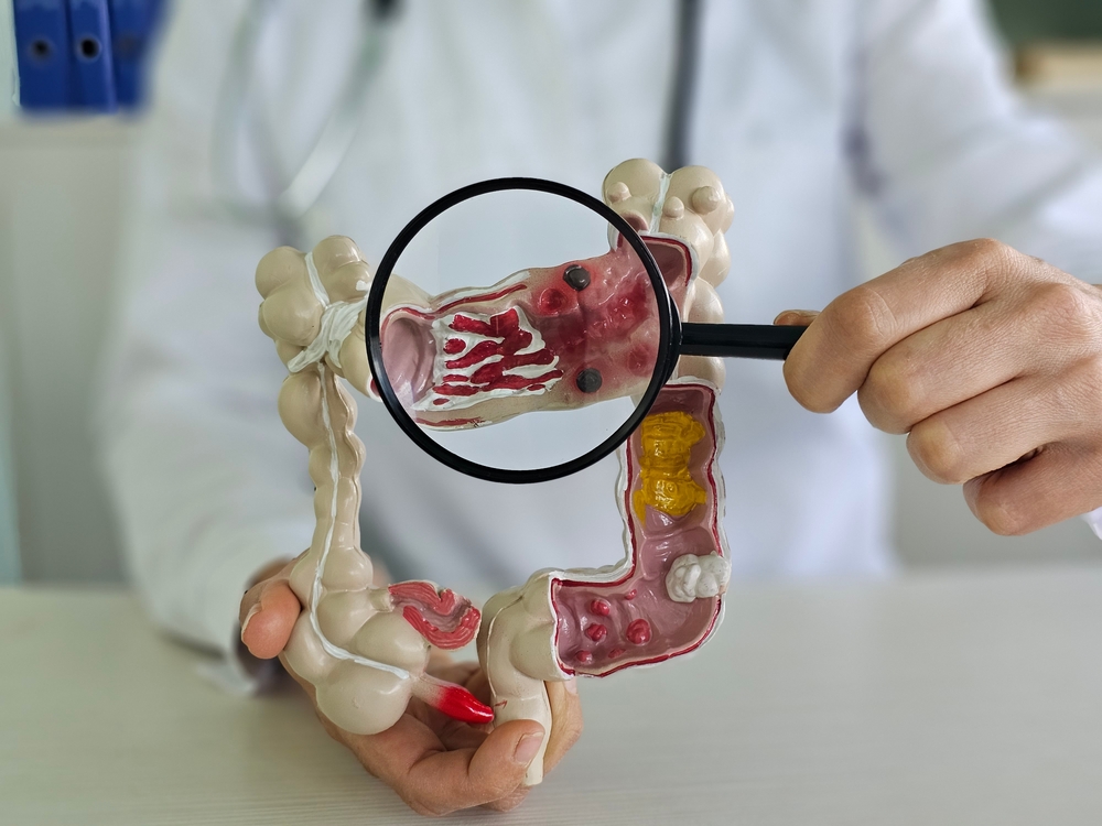 Are My Symptoms IBD or Colon Cancer? - Allied Digestive Health